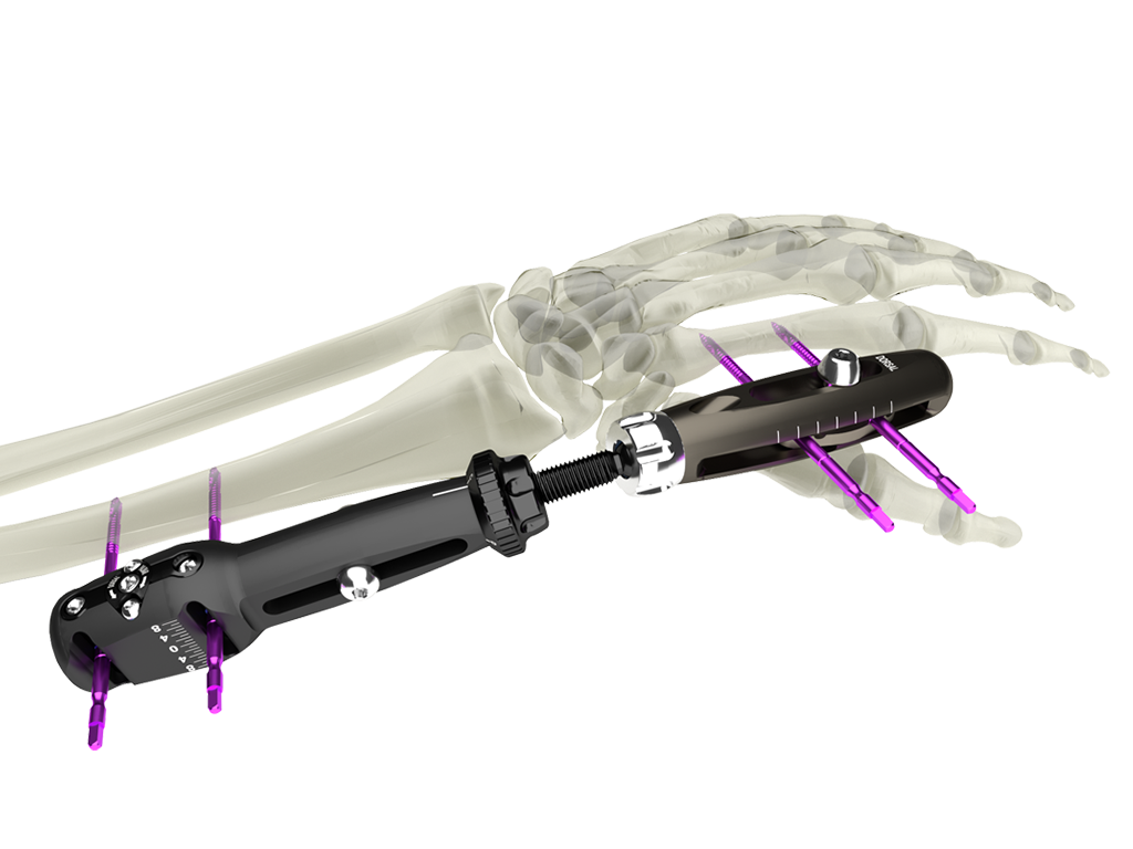 Produkte für die Kinderorthopädie, Rekonstruktion und Frakturversorgung ...